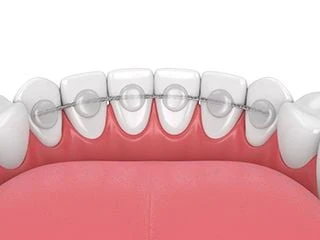 Orthodontic Retention - Towne Centre Family Dental and the Implant ...